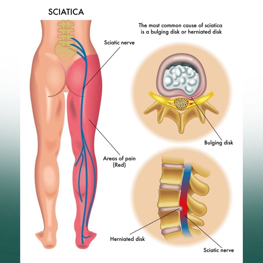 SciaEase™ | Natural Sciatica Cream – Serene-Sense